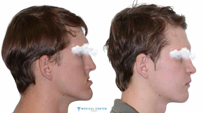 What Surgery is Best? 5 Types of Jaw Surgery in Turkey - Medical Center ...