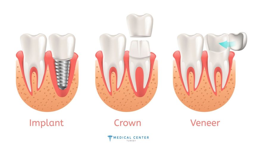 Veneers vs. Crowns: A Guide to Choosing the Best Option in Turkey ...