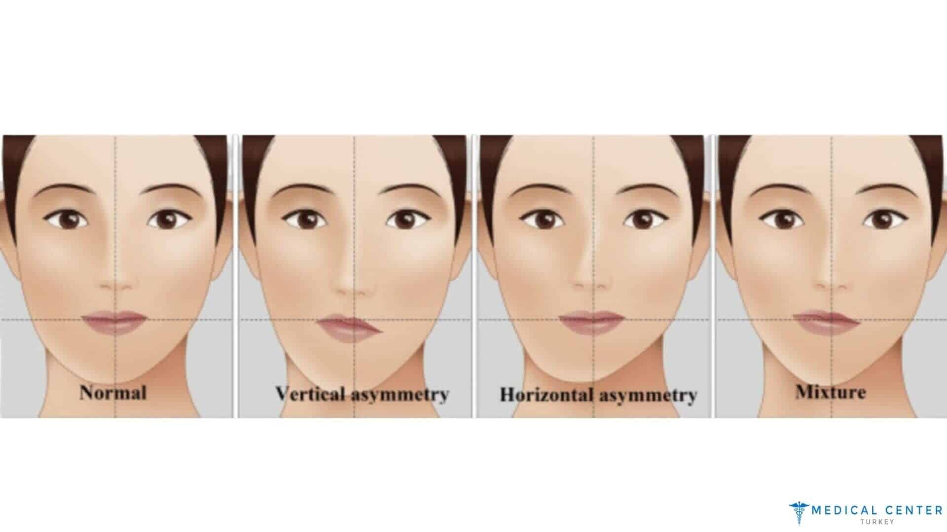 Achieving Symmetry: Asymmetry Correction Procedures in Turkey - Medical ...