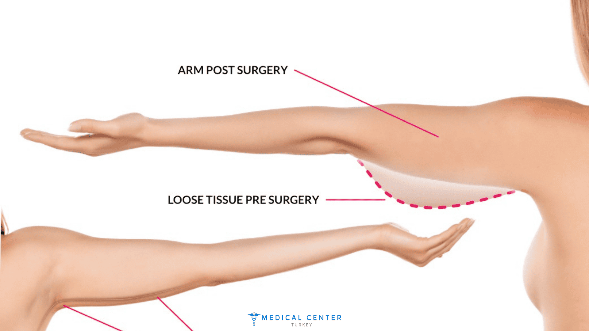 Mini Arm Lift in Turkey: A Quick Fix for Sagging Skin - Medical Center ...